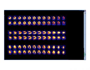 Nuclear Stress Test | Dr Paul Ong Heart Clinic